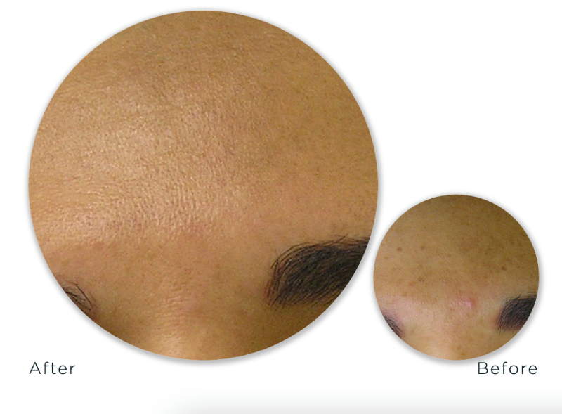 Before and After | Soma Medical Spa