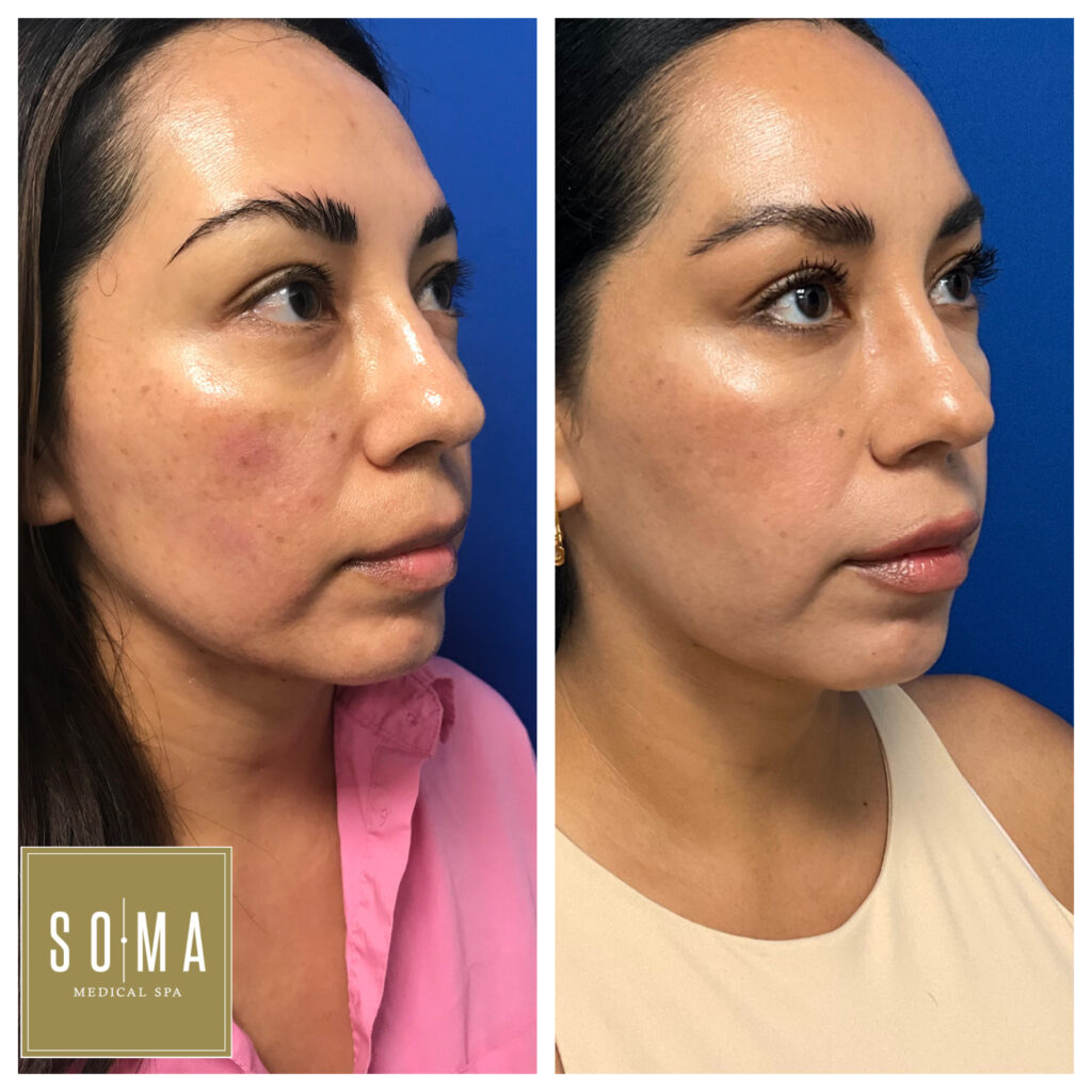 Sculptra PLLA Dermal Fillers in Glendale, CA